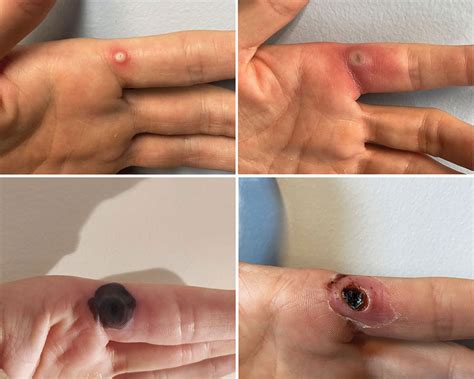 Loms Dichiara La Fine Dellemergenza Sanitaria Pubblica Del Vaiolo
