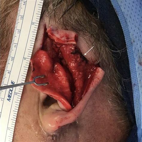 The Posterior Auricular Skin Is Elevated Off The Auricular Cartilage Download Scientific