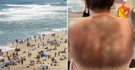 해변서 3시간 보낸 후 몸에 3도 화상선크림 믿었다 낭패 Snsfeed 제휴콘텐츠 제공 실시간 핫이슈