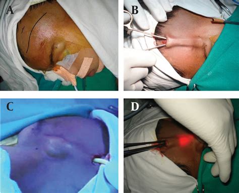 A Angular Dermoid Over Left Side Of Eyebrow B Creation Of