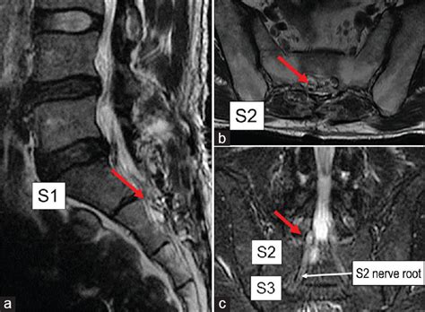Resection And Imbrication Of Symptomatic Sacral Tarlov Cysts A Case