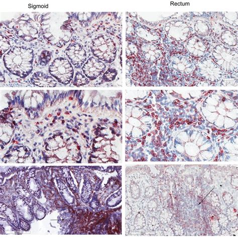 Cd3 Lymphocytes Are Similar In Normal Human Sigmoid Colonic And Rectal