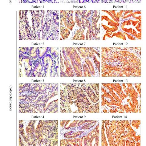 High Expression Of Acy1 Is Associated With Lymph Node Metastasis And Download Scientific