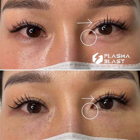 플라즈마블라스트 콜드플라즈마 본점 라엘속눈썹리프팅속눈썹파마 차이점확실한 리프팅비교불가호주정품 엘리바나레쉬리프트예약문의 0234472211 Facebook