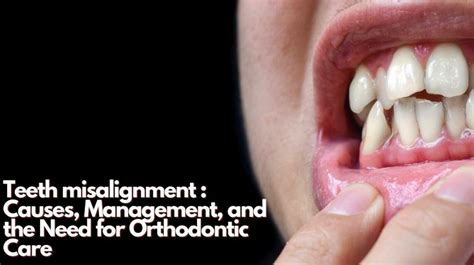 Understanding Teeth Misalignment Causes Management And The Need For Orthodontic Care