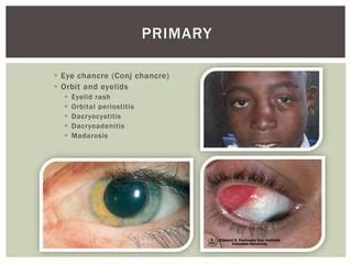 Ocular Manifestations Of Syphilis Pptx