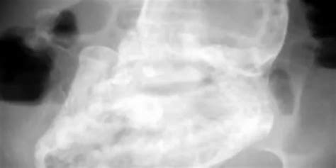 Video 40 Year Old Fetus Found Inside Elderly Woman Huffpost