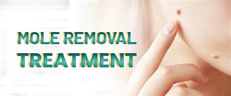 Mole Removal Treatment In Islamabad Pakistan