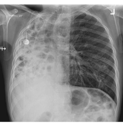 Chest Radiograph Around 6 Months Post Pneumonectomy Download