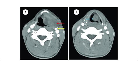 Preoperative Enhanced Ct Images Showing A Mass Of Irregular Density