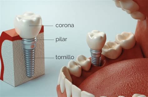Explicamos Las Partes De Un Implante Dental IMED Dental