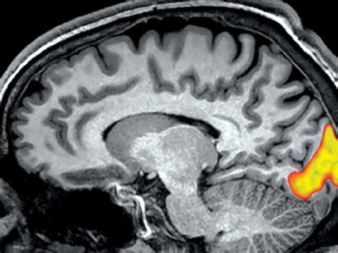 Intelligent Brain Mri