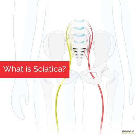 What Is Sciatica Ultimate Health