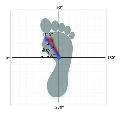 Ilizarov Tibial Lengthening In The Skeletally Immature Patient Bone