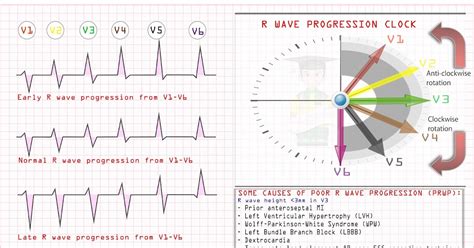 Ecg Educator Blog R Wave Progression