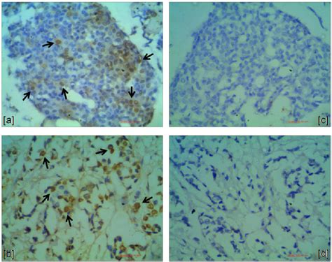 Ebna1 Positive Cases A And B Breast Carcinomas Nuclear Staining In A