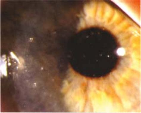 Cornea Ento Key