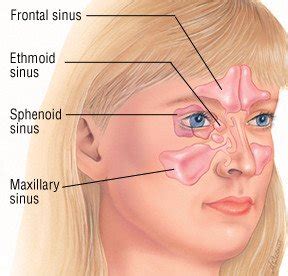 Acute Sinusitis Guide Causes Symptoms And Treatment Options