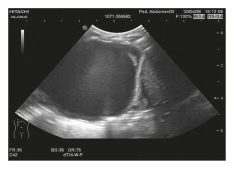 Ultrasound Indicates Irregular Hyperechoic Or Mixed Echo Areas