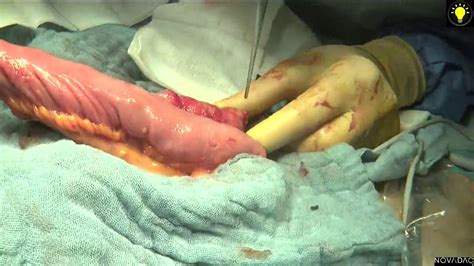 Laparoscopic Restorative Proctectomy With Ileal J Pouch In Patient With