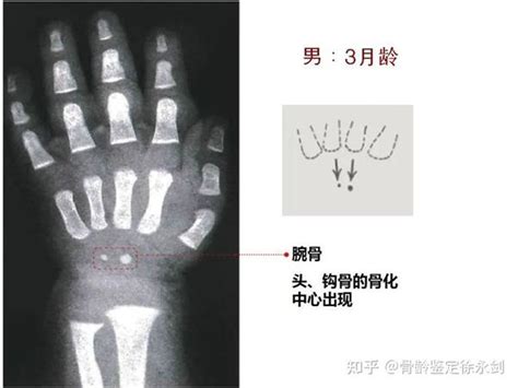 详解骨龄检测G P骨龄图谱男生版 知乎