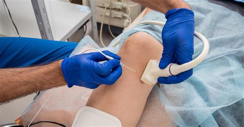 Radiofrequency Ablation Procedure Visp