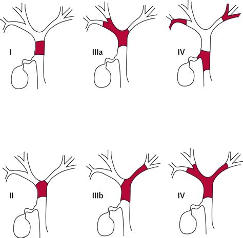 Cholangiocarcinoma The Lancet