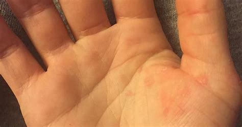 Eczema Album On Imgur