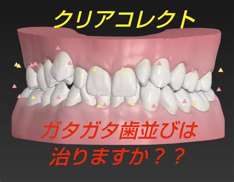 インビザラインのジェネリック クリアコレクトのモニターは当医院の インプラント オペ担当の看護師 お口の再生博士 歯並びブログ 広島
