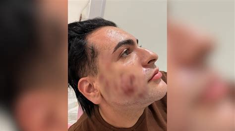Homem Que Morreu Em Clínica De Sp Pagou R 4500 Por ‘peeling De Fenol