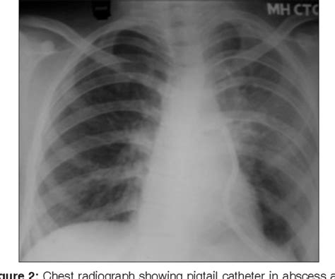 Figure 2 From Fibrinolytics In Loculated Abscess Cavities A Report Of