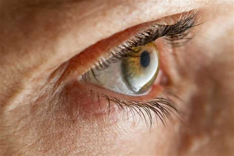 10 Tips Para Prevenir El Glaucoma TSMNoticias