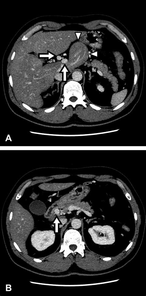 Contrast Enhanced Computed Tomography Showing An Enlarged Caudate Lobe
