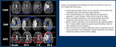 Brain Acute Stroke Philips Mr Body Map