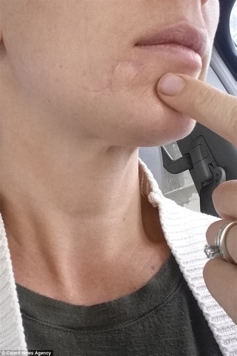 California Mother Dismissed Skin Cancer As A Blackhead Daily Mail Online
