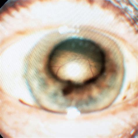 Bullous Retinal Detachment Suggestive Of A Subretinal Mass Download