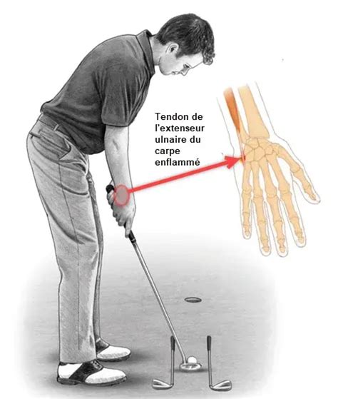 Extensor Carpi Ulnaris Tendonitis Causes And Treatment Osteomag