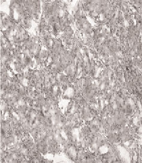 Shows Large Polyhedral Cells With Small Hyperchromatic Nuclei And