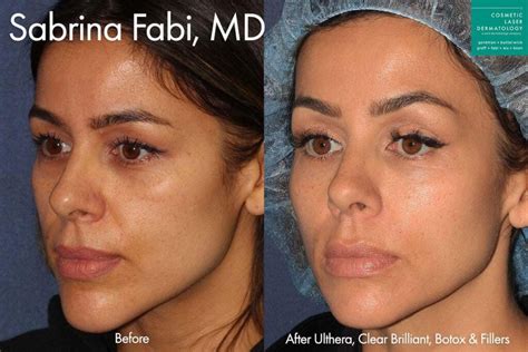 Botox Brow Lift In San Diego Expert Treatment For Hooded Eyes