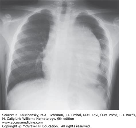 Acute Lymphoblastic Leukemia Oncohema Key