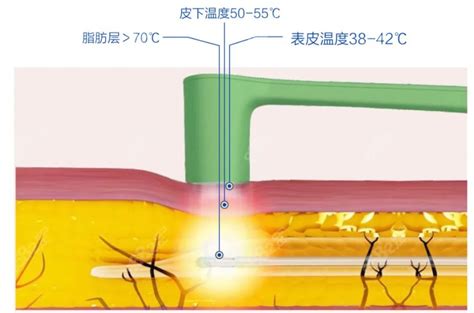 黄金微雕恢复过程图：做完40天好丑但90天后脸瘦了好多吸脂对比照 8682整形网