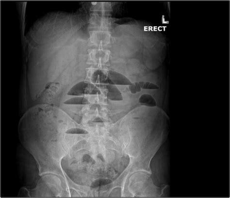 An Abdominal X Ray Divulging Multiple Air Fluid Levels Within The Download Scientific Diagram
