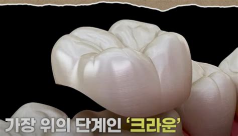 크라운 치료 가격 비용이 다른 이유 병원 선택 팁 네이버 블로그