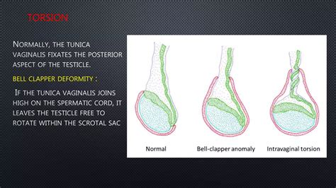 Ultrasound Scrotum Pptx