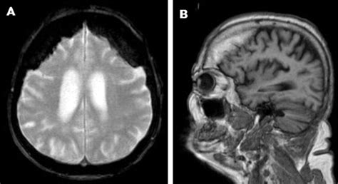 Frontal Cortex Dysfunction Due To Extensive Hyperostosis Frontalis