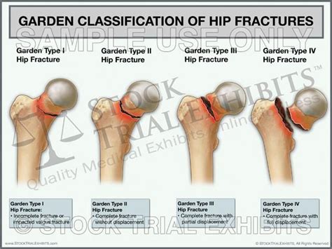 This Trial Exhibit Depicts The Standard Garden Classification Of Hip