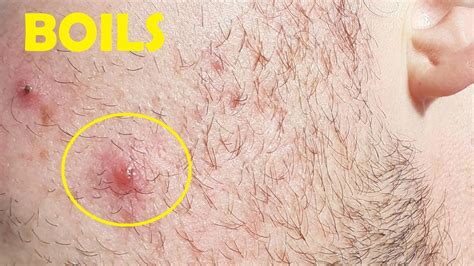 How Long Do Heat Boils Last At Marsha Leach Blog