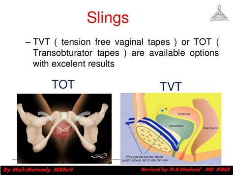 How Long Does A Bladder Sling Surgery Last At James Loch Blog