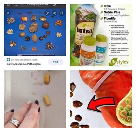 Intra Lifestyles Health Is Wealth Ano Nga Ba Ang Bato Sa Apdo O Gallstones At Anu Ano Ang Mga