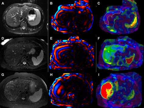 Examples Of Magnetic Resonance Elastography Mre Axial T2w Images A Download Scientific